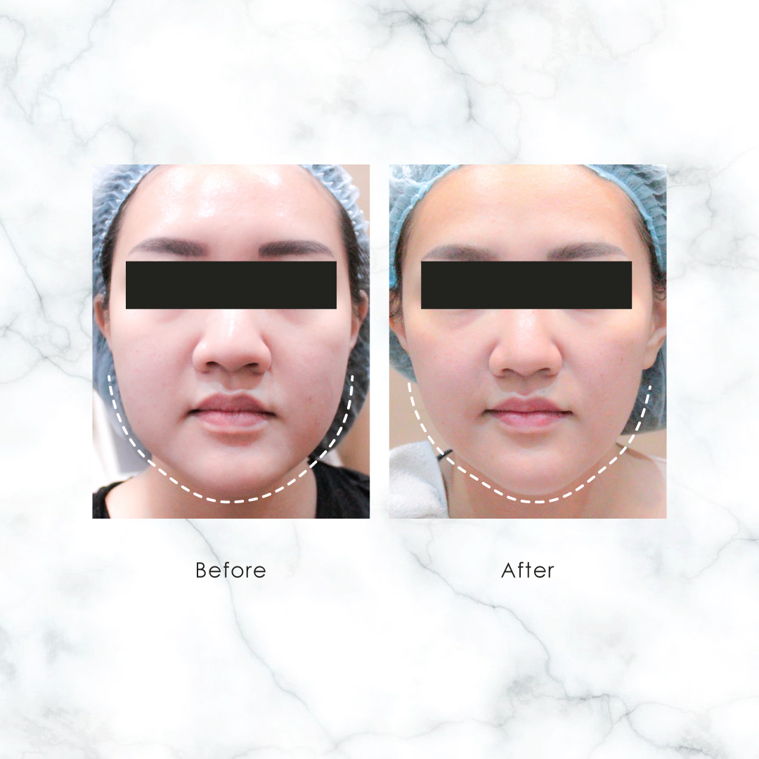 MMFU & HIFU - Facena | Story Beyond Beauty